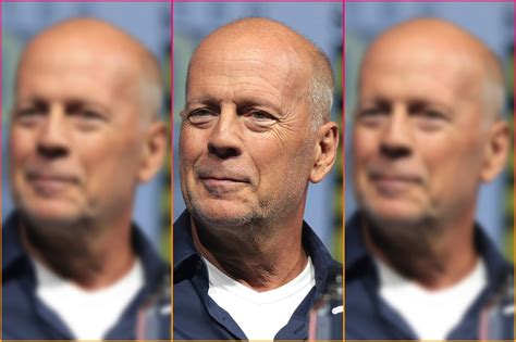 Bruce Willis Hair Loss