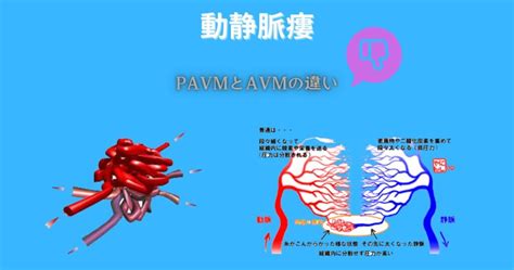 PAVM肺動静脈瘻とAVM動静脈奇形その違いの解説 オスラー病患者会