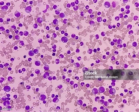 慢性骨髄増殖性腫瘍血液がんの種類慢性白血病 カラー画像のストックフォトや画像を多数ご用意 カラー画像 バングラデシュ リンパ球