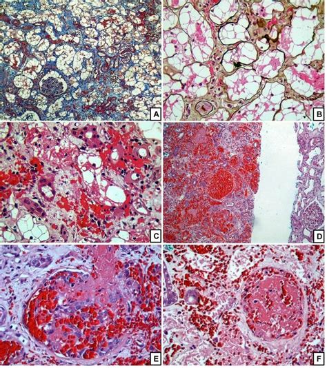 Transmission Electron Microscopy Of Renal Tissue From Patients