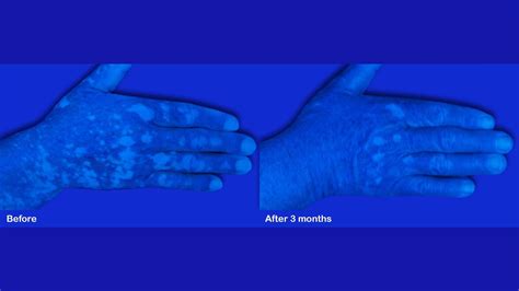 Cases Of Vitiligo On The Upper And Lower Limbs Vitiligo Center