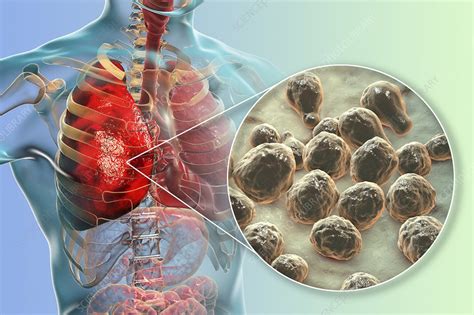 Pulmonary Cryptococcosis Illustration Stock Image F0338019 Science Photo Library
