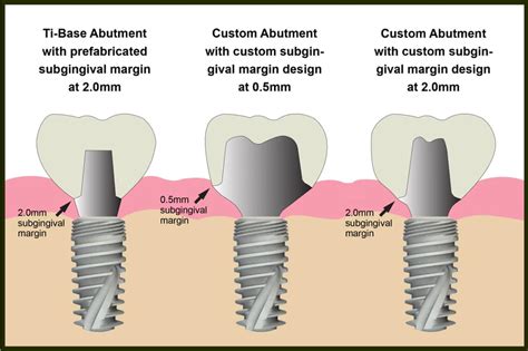 Arklign When Considering Abutment Margin Depth And To