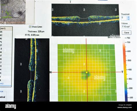 Oct Of The Eye Reveals Faint Epimacular Membrane And Full Thickness