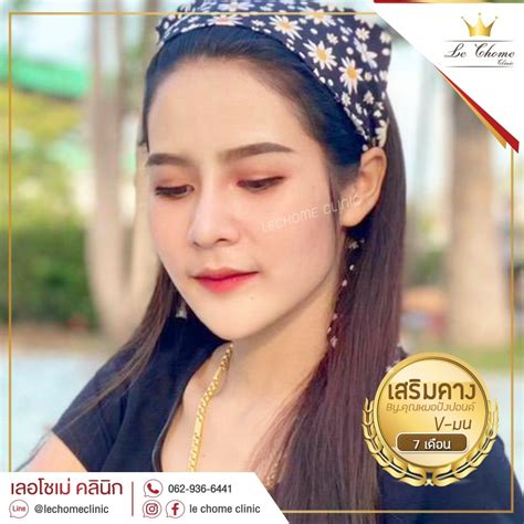 จะเผลอมุมไหนก็เป๊ะ‼️ กับเคสเสริมคาง หลังทำ 7 เดือน โดยคุณหมอปังปอนด์👨🏻
