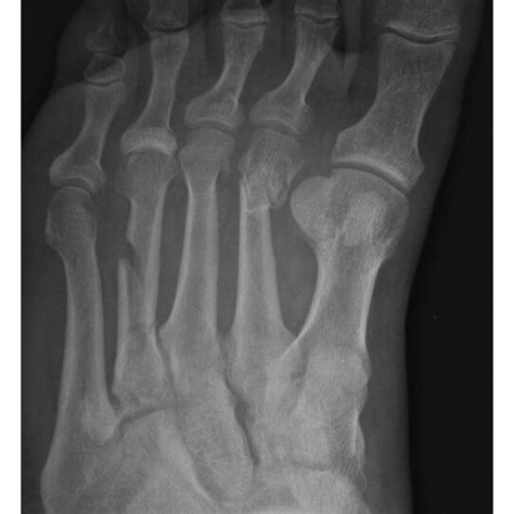 Dorsoplantar A Oblique B And Lateral C Radiographs Of The Left