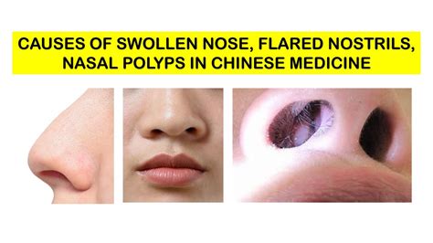 Swollen Nose Flapping Of Alae Nasi Nasal Polyps Youtube
