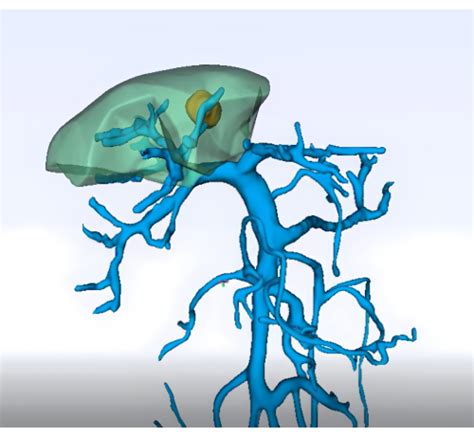 Minimally Invasive Anatomic Resection Of Liver Segment Viii Based On Portal Territory To Treat