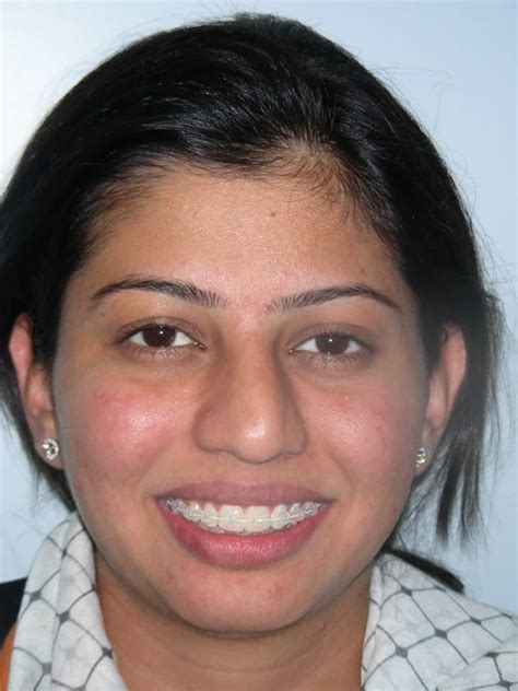 Pin On Patient Orthodontics Bracestestimony