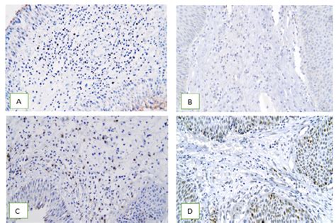 Foxp3 Cd4 Cd8 And P53 Expression In Sip With Dysplasia Group A