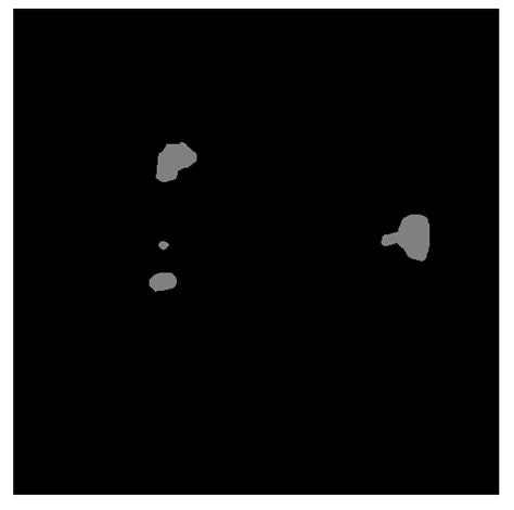 A Deep Learning Based Diagnosis System For COVID Detection And Pneumonia Screening Using CT