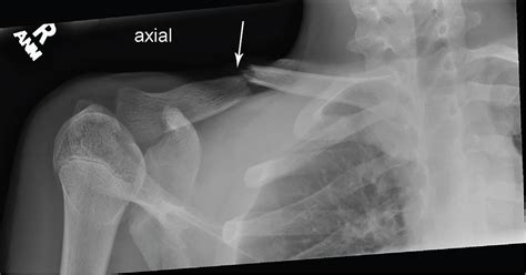 In Pieces Clavicle Fracture Clinical Tree