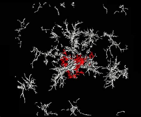 Some Alzheimers Plaques May Be Protective Not Destructive