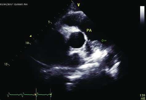 A Case Of Acute Pulmonary Embolism With Saddle Shaped Thrombus At