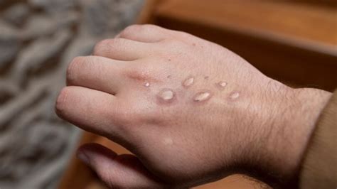 Why We Have Cows To Thank For The Eradication Of Smallpox Health