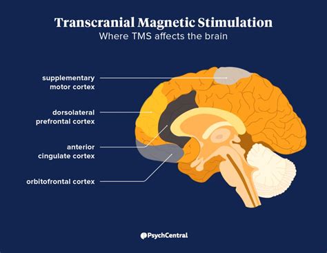 Is Tms Treatment Effective For Ocd
