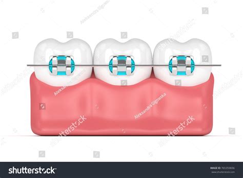 3d Render Teeth Braces Isolated Over Stock Illustration 765359836