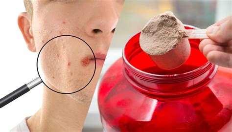 Link Between Whey Protein And Acne Insights By David Winston