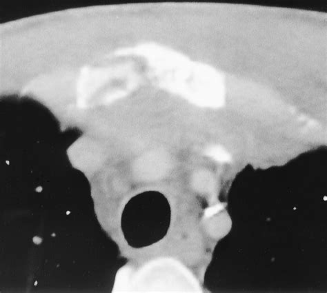 19 18 Nodular Sclerosing Hodgkin Disease In A 24 Yearold Man A