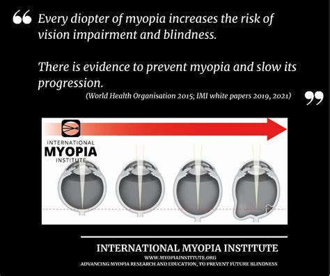 Dr Monica Jong Od Phd On Linkedin Myopia Myopiaawarenessweek