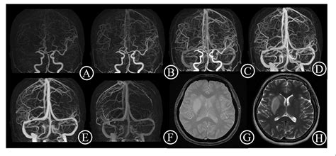 Figure 1 From Collateral Vessels On 4d Cta As A Predictor Of Hemorrhage