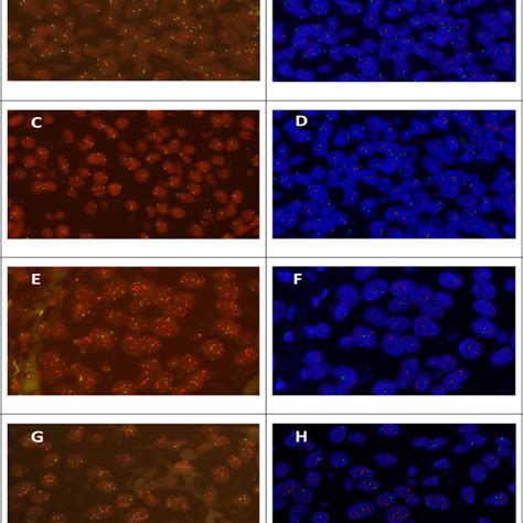 PDF Assessment Of HER2 Amplification Status In Breast Cancer Using A