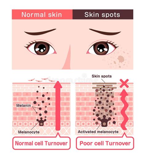 Illustration Of How Skin Spots Hyperpigmentation Are Created Stock Vector Illustration Of Illustration Of How Skin Spots Hyperpigmentation Are Created Stock Vector Illustration Of