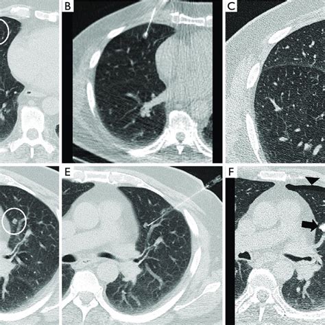 Marking Using The Roll Technique Of Two Nodules One In Each Lung For Download Scientific
