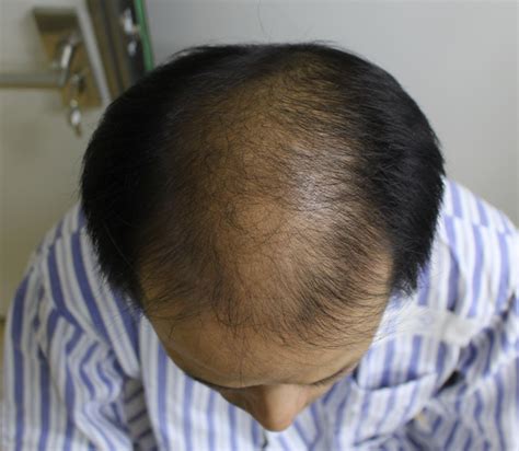 脂溢性脱发，植发后还要用药吗？ 知乎