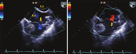 Tee Showing Right Atrial Pseudoaneurysm And Color Flow Saline Into The Download Scientific