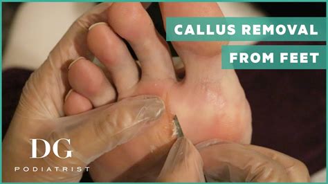 Callus Removal From Feet Small Seed Corn Youtube