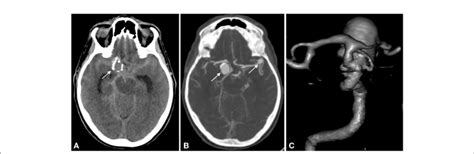 Figure Ncct Subarachnoid Hemorrhage In The Basal And Sylvian Cistern Download Scientific