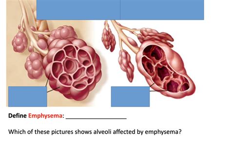 Emphysema Diagram Quizlet
