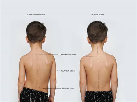 Spinal Deformityhow To Overcome Causes Symptoms Andtreatment