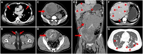 Choriocarcinoma Pathology Outlines Choriocarcinoma