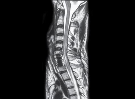First Postoperative Day T2 Weighted Sagittal Section Of Mri Cervical