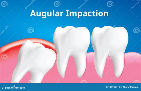 Wisdom Tooth Angular Or Mesial Impaction With Inflammation Affect Dental Concept Realistic