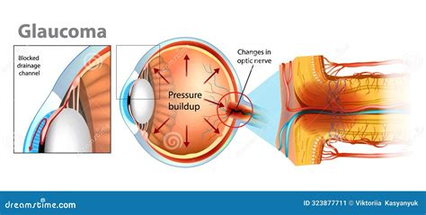Glaucoma Is A Group Of Eye Diseases That Lead To Damage Of The Optic