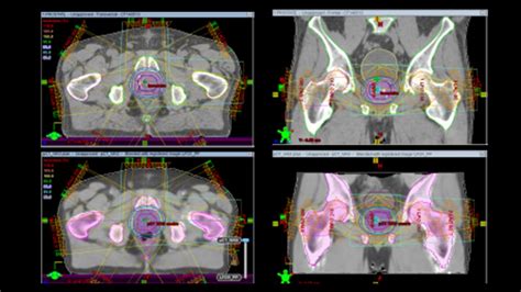Mr Only Radiotherapy Planning With Synthetic Ct Siemens Healthineers