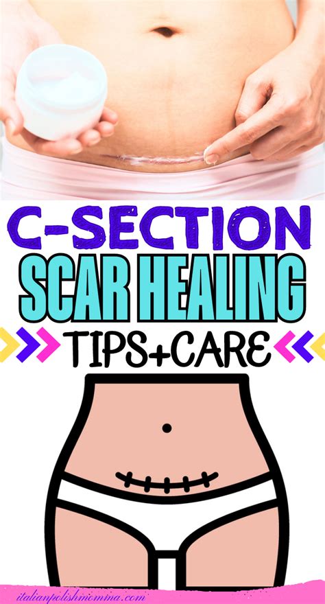 12 C Section Recovery Tips To Heal Fast C Section C Section Recovery