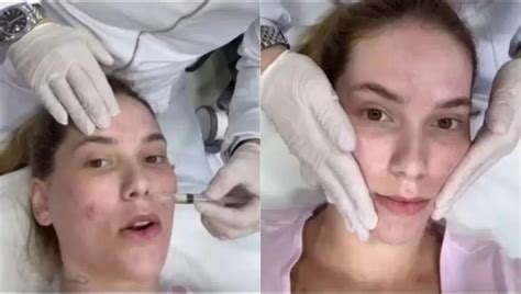 Esperma de salmão no rosto entenda tratamento usado por Virginia