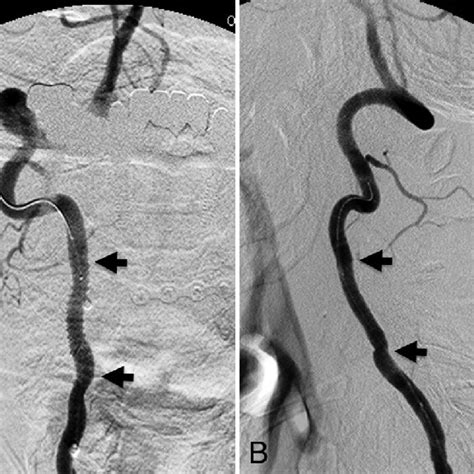 Digital Subtraction Angiography Of The Right Vertebral Artery Shows An