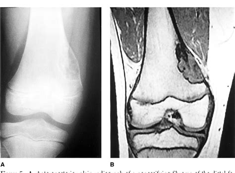 Figure 5 From Metaphyseal Fibrous Defects Semantic Scholar