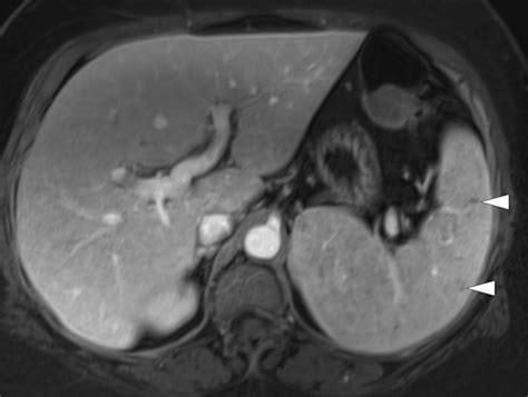 Cross Sectional Imaging Findings Of Splenic Infections Is Differential