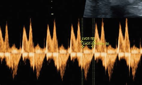 Tei Index Measurement Download Scientific Diagram