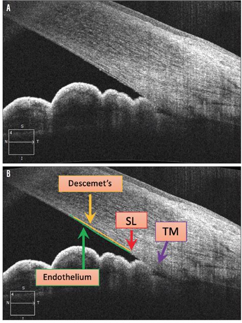 Anterior Segment Oct Precision Angle Imaging Glaucoma Today