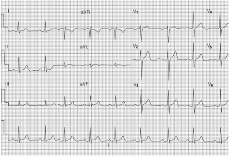 Normal Ecg Wave Pattern