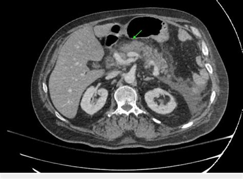 Computed Tomography Ct Finding Of Acute Pancreatitis Arrow Depicts