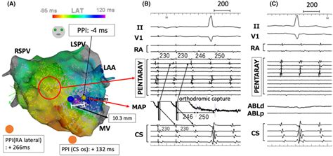 A Lat Map During Atrial Tachycardia Blue Solid Circle Indicates