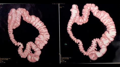 Lap Sigmoidectomy With Preservation Of The Superior Rectal Artery For
